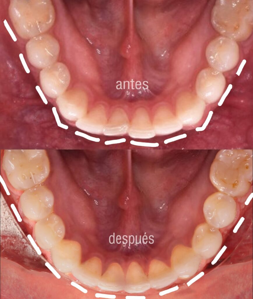 Ortodoncia Invisible en Medellín | Dental Home